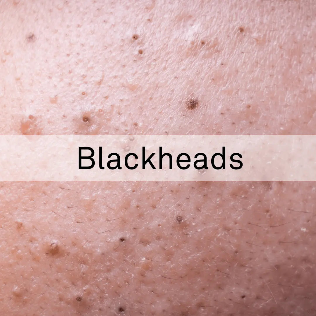 Blackheads – Bravuralondon.com