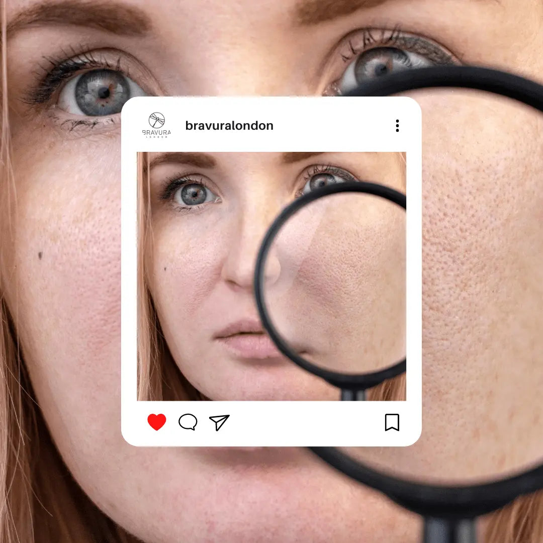 Enlarged Blocked Pores – Bravuralondon.com